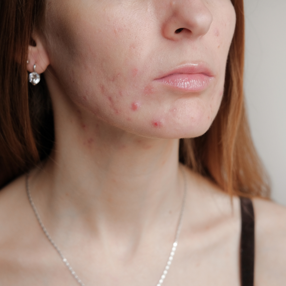 Acne | SAM Clinic