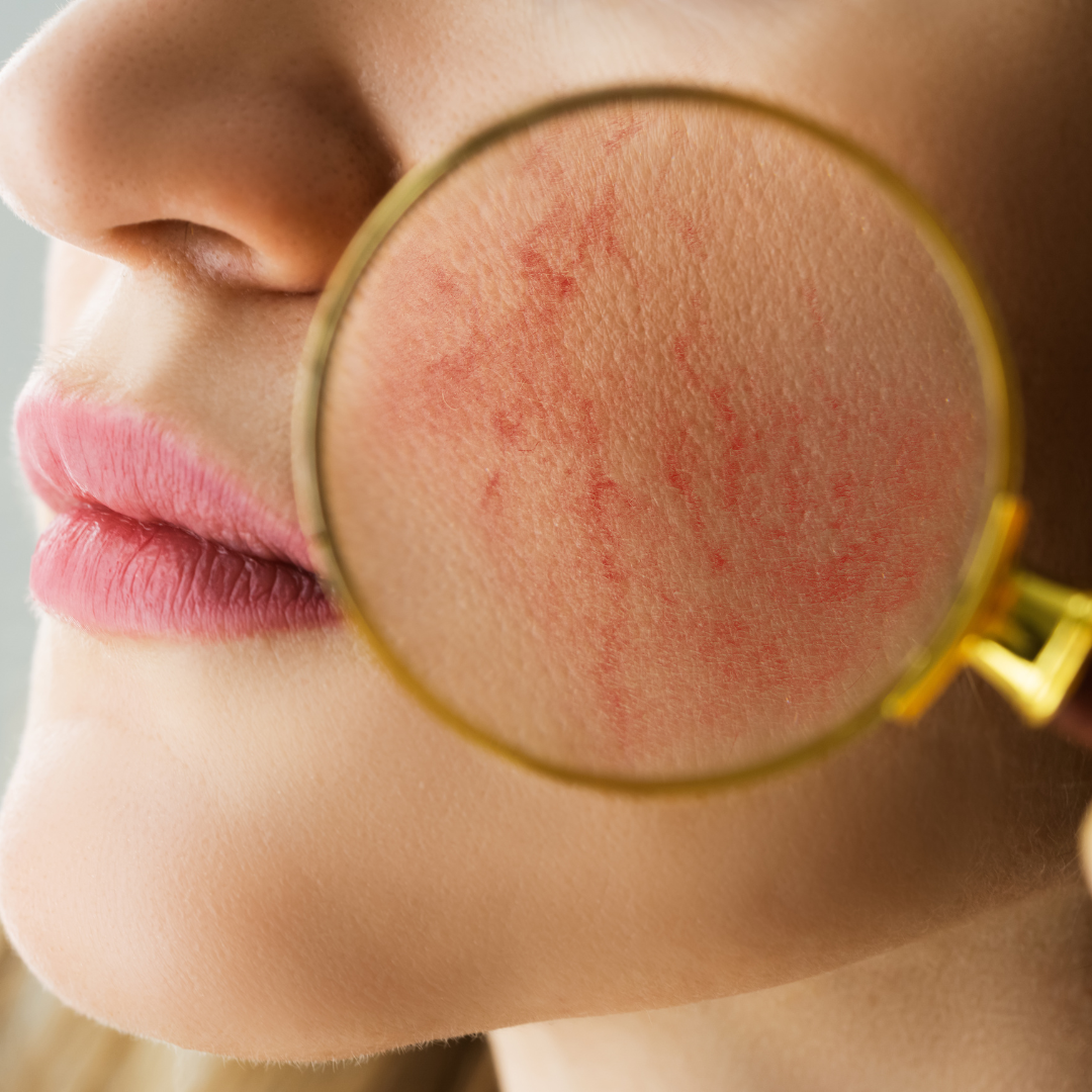 Skin Redness and Rosacea | SAM Clinic
