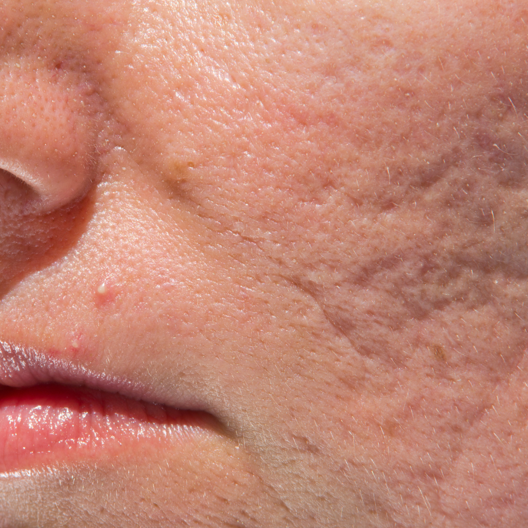 Acne Scarring | SAM Clinic